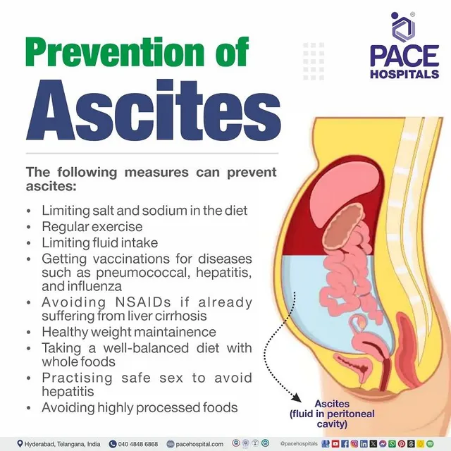 Ascites, Treatment And Prevention - Edition Time