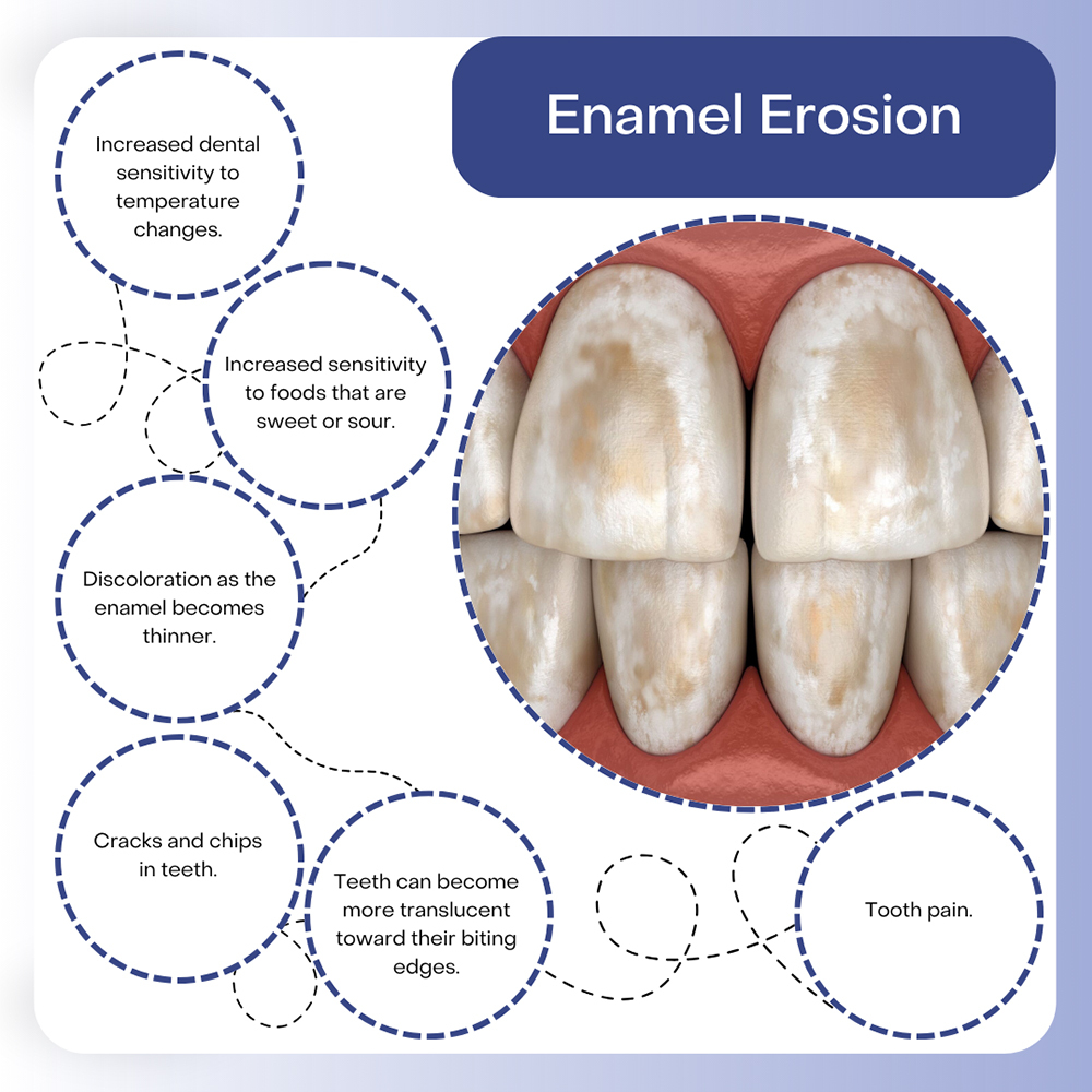 Dental Erosion: Treatment And Causes - Edition Time
