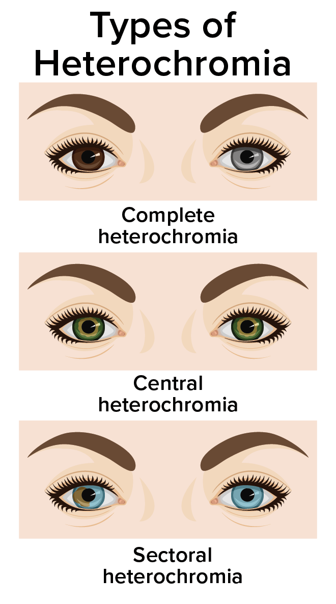 Heterochromia: What Does it Mean - Edition Time