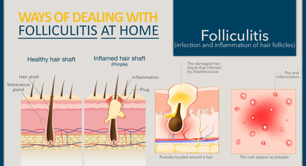 Folliculitis: Symptoms And Treatments - Edition Time