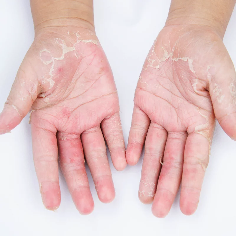 Skinned Hands: Causes And Remedies - Edition Time