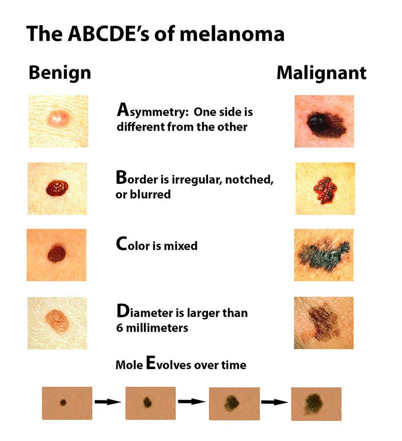 Dangerous Moles: How to Recognize Them - Edition Time